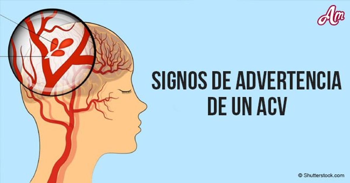 Cómo detectar las primeras señales de advertencia de un ACV