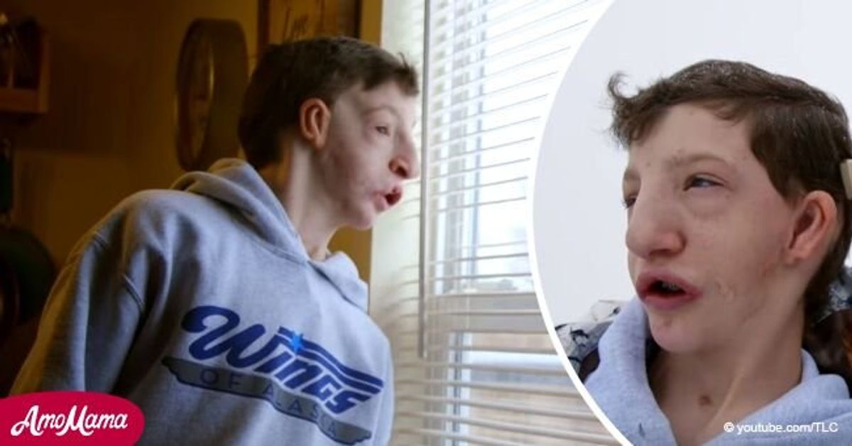 Niño con síndrome raro fue intimidado por su apariencia. Hasta que ...