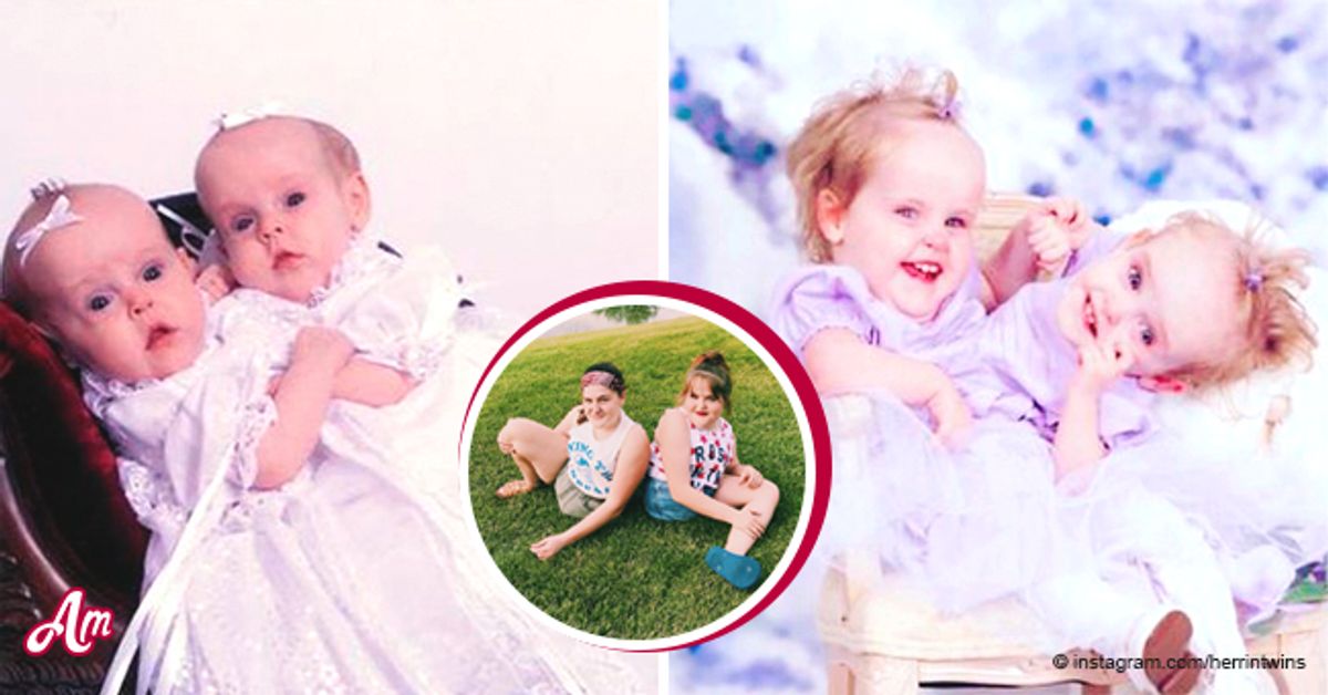 Mellizas siamesas separadas en arriesgada cirugía hace 13 años ya son ...