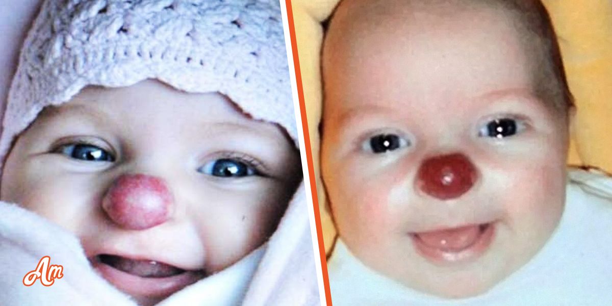 A niña nacida con la nariz roja la llamaban cruelmente "Rudolph ...