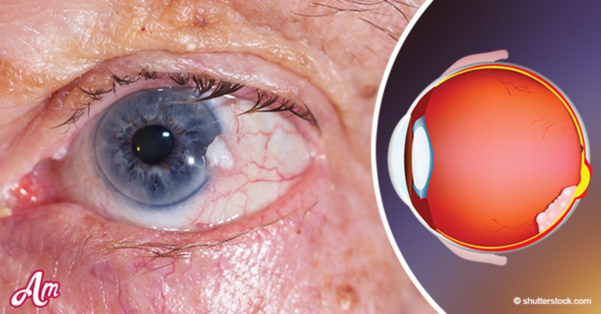 Síntomas del cáncer de ojo que debes conocer